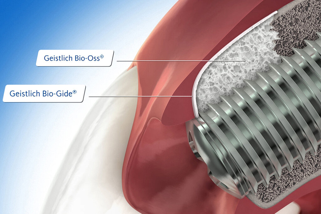 Geistlich USA: Minor Bone Augmentation