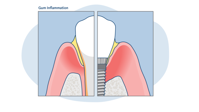 Geistlich USA: Dental Implants