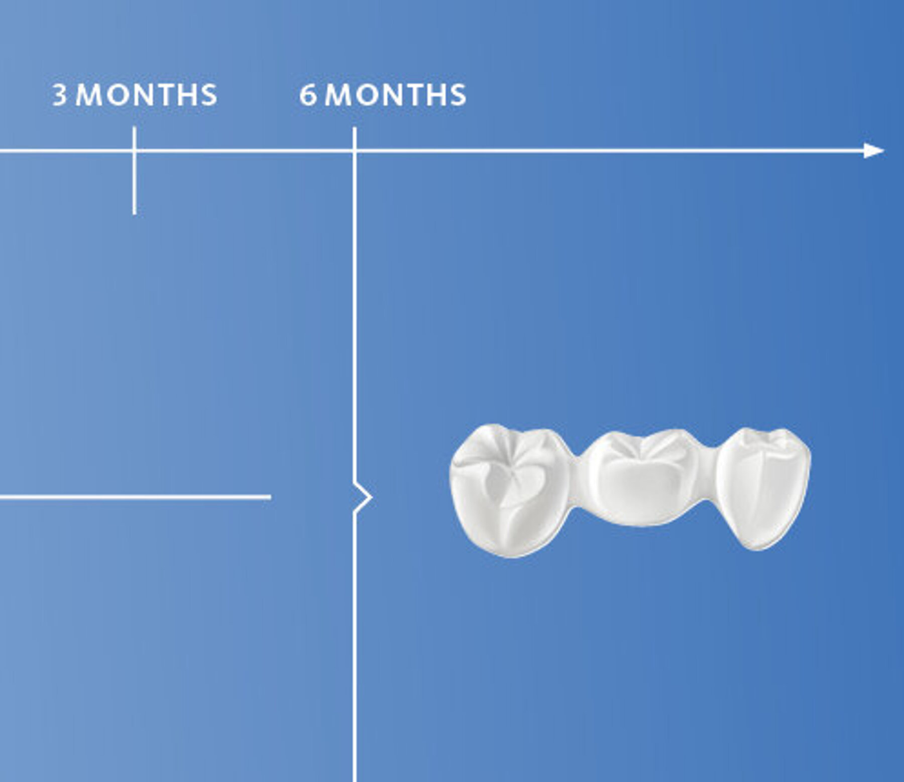 Geistlich USA: Extraction Socket Management