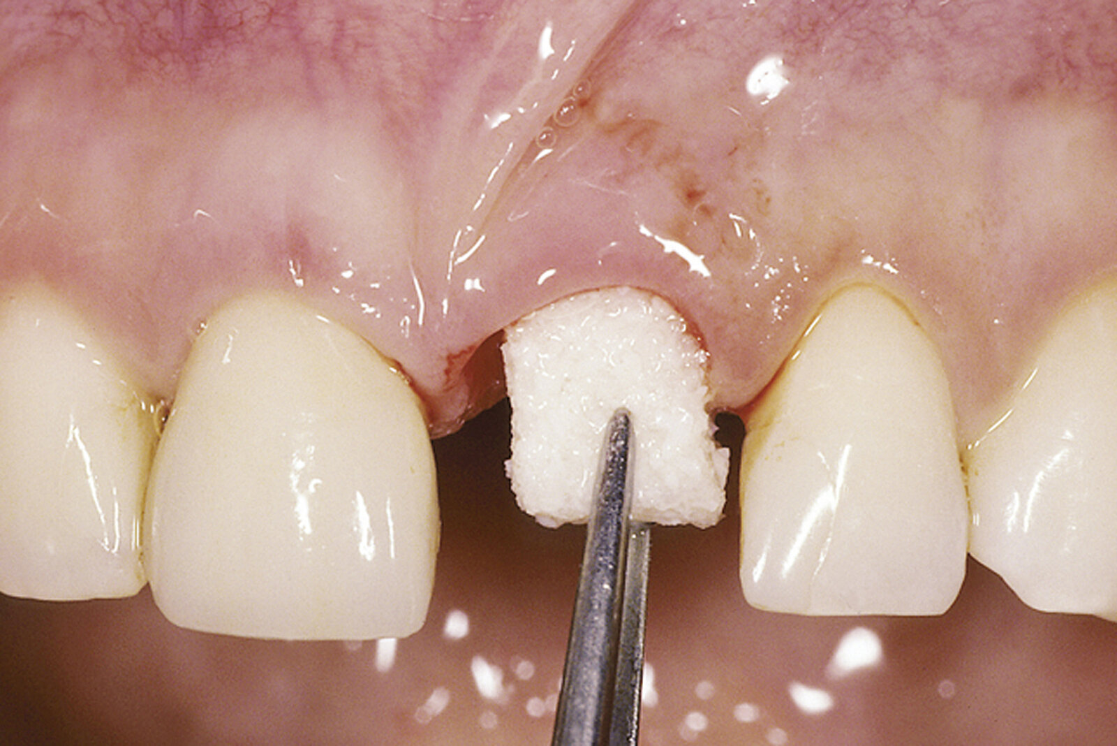 Geistlich USA: Geistlich Bio-Oss Collagen