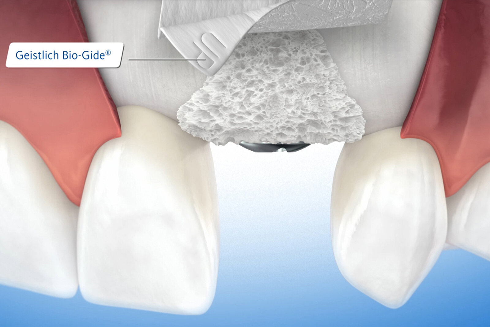 Geistlich USA: Minor Bone Augmentation