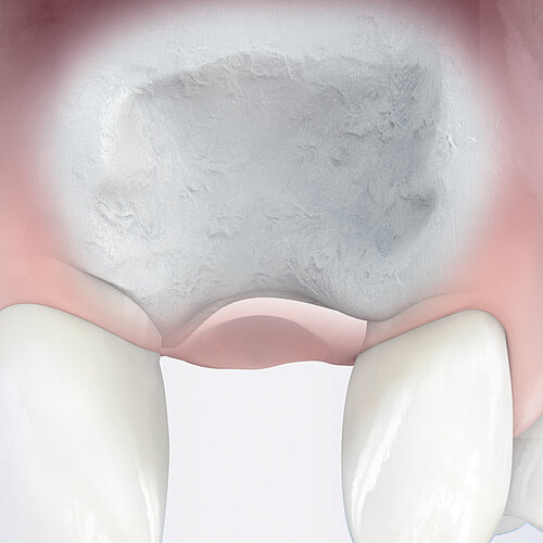 Geistlich USA: Geistlich Bio-Oss