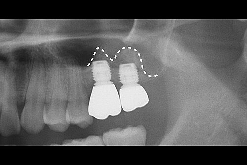 Geistlich USA: Crestal Sinus Floor Elevation
