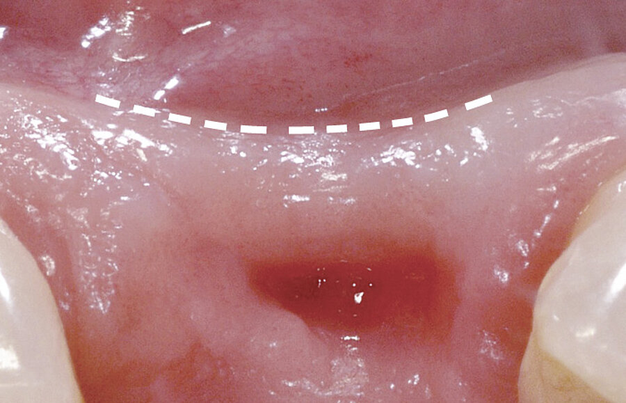 Geistlich USA: Extraction Socket Management
