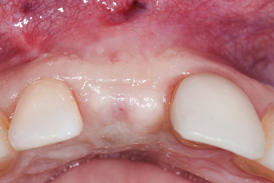 Geistlich USA: Soft-Tissue Thickness Augmenation