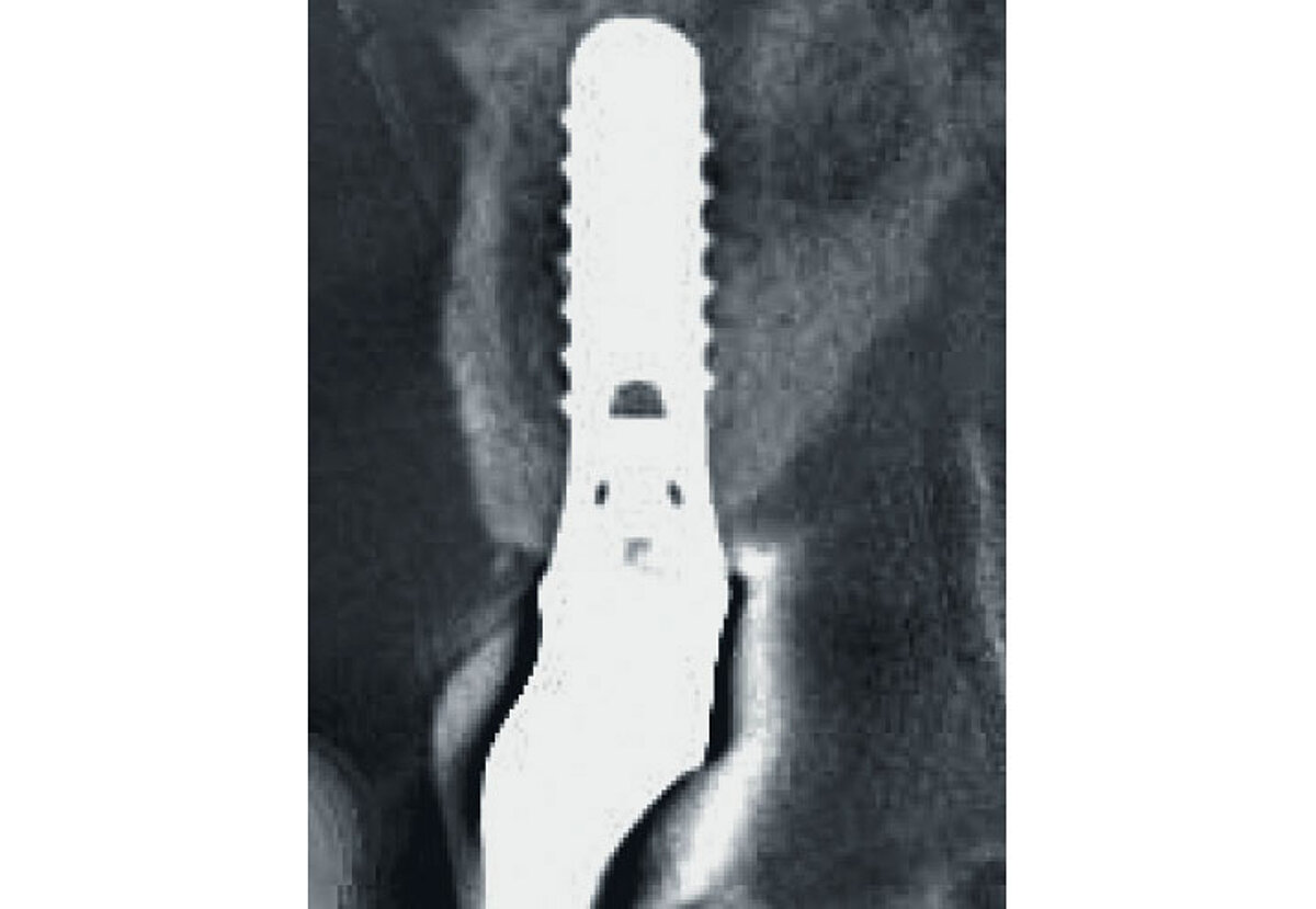 Geistlich USA: Bone Harvesting Instruments