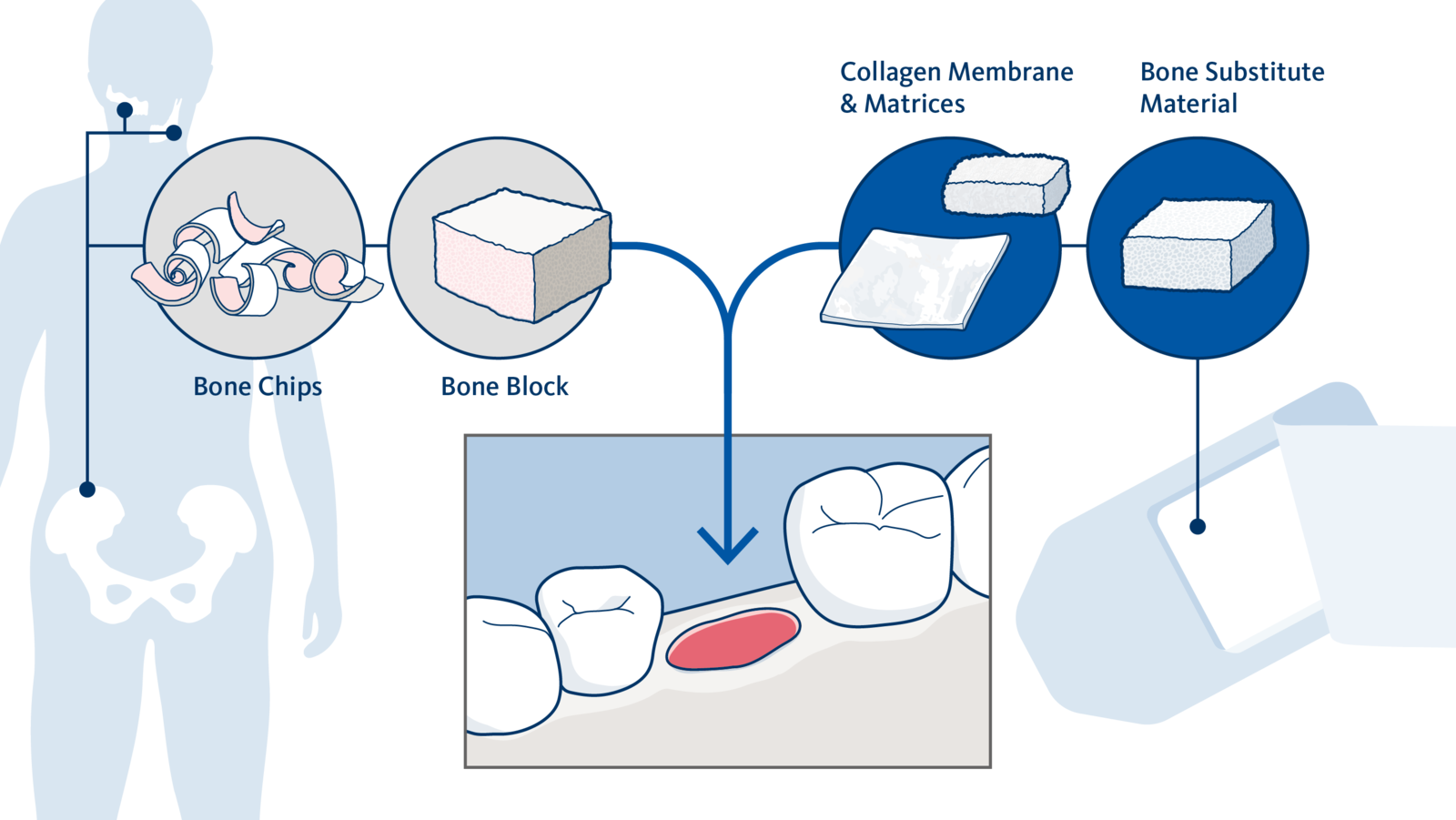 Geistlich USA: Dental Implants