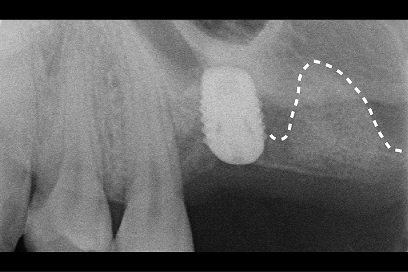 Geistlich USA: Crestal Sinus Floor Elevation