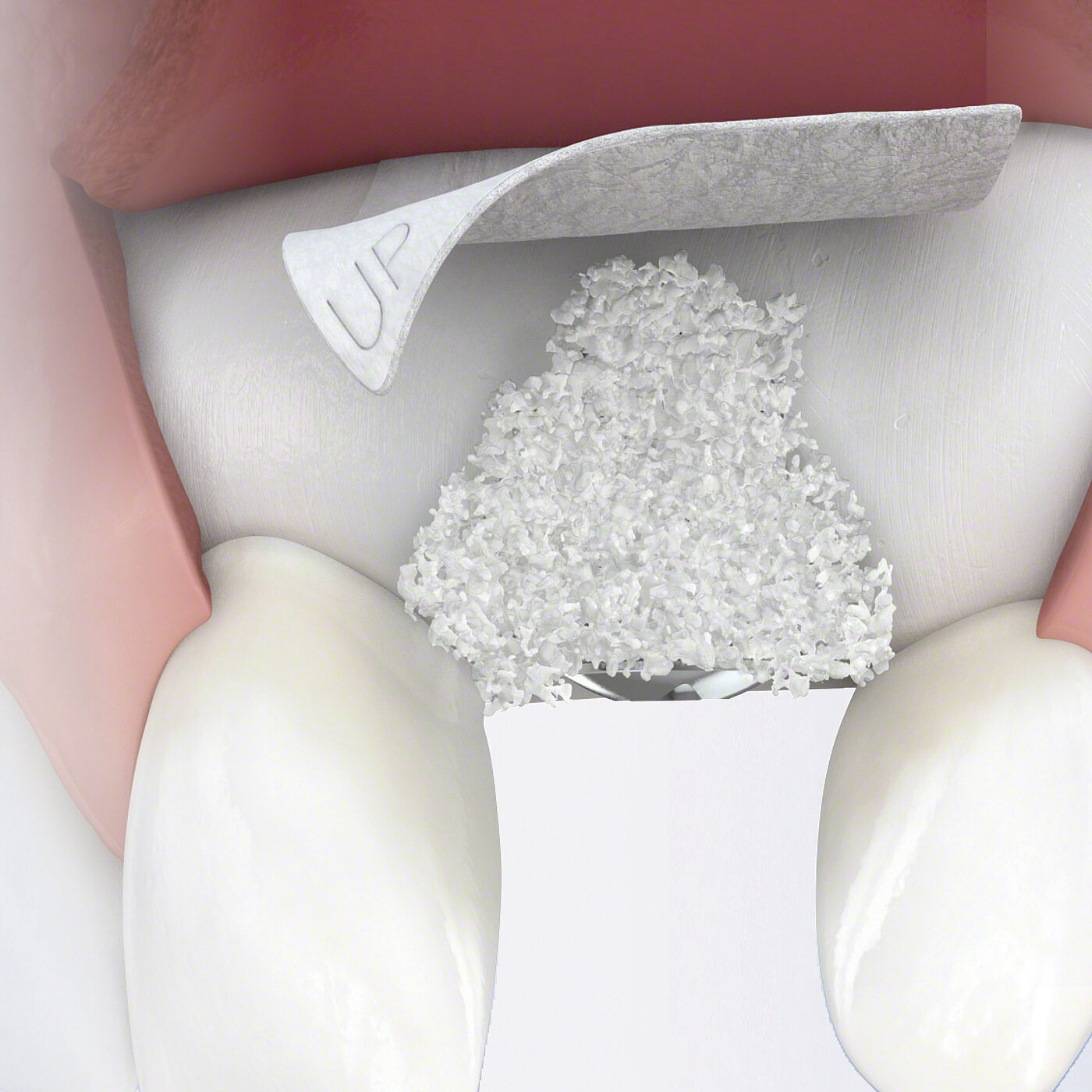 Geistlich USA: Geistlich Bio-Oss