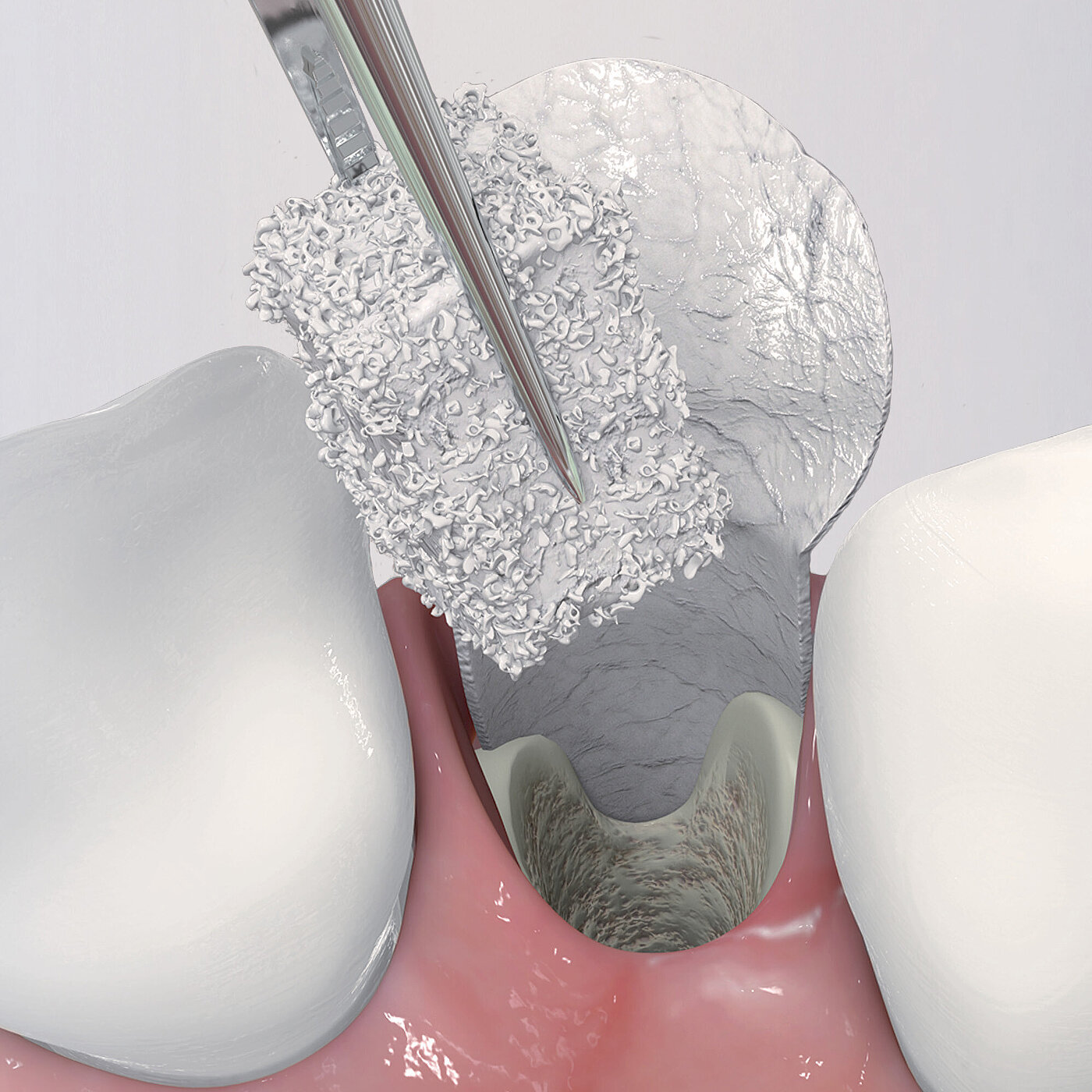 Geistlich USA: Geistlich Bio-Gide
