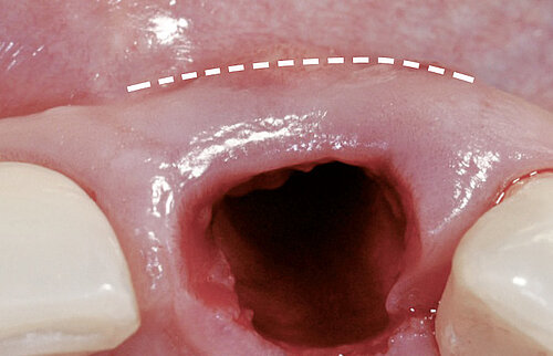 Geistlich USA: Extraction Socket Management