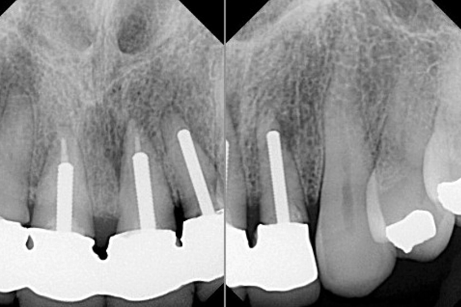 Geistlich USA: No implant placement