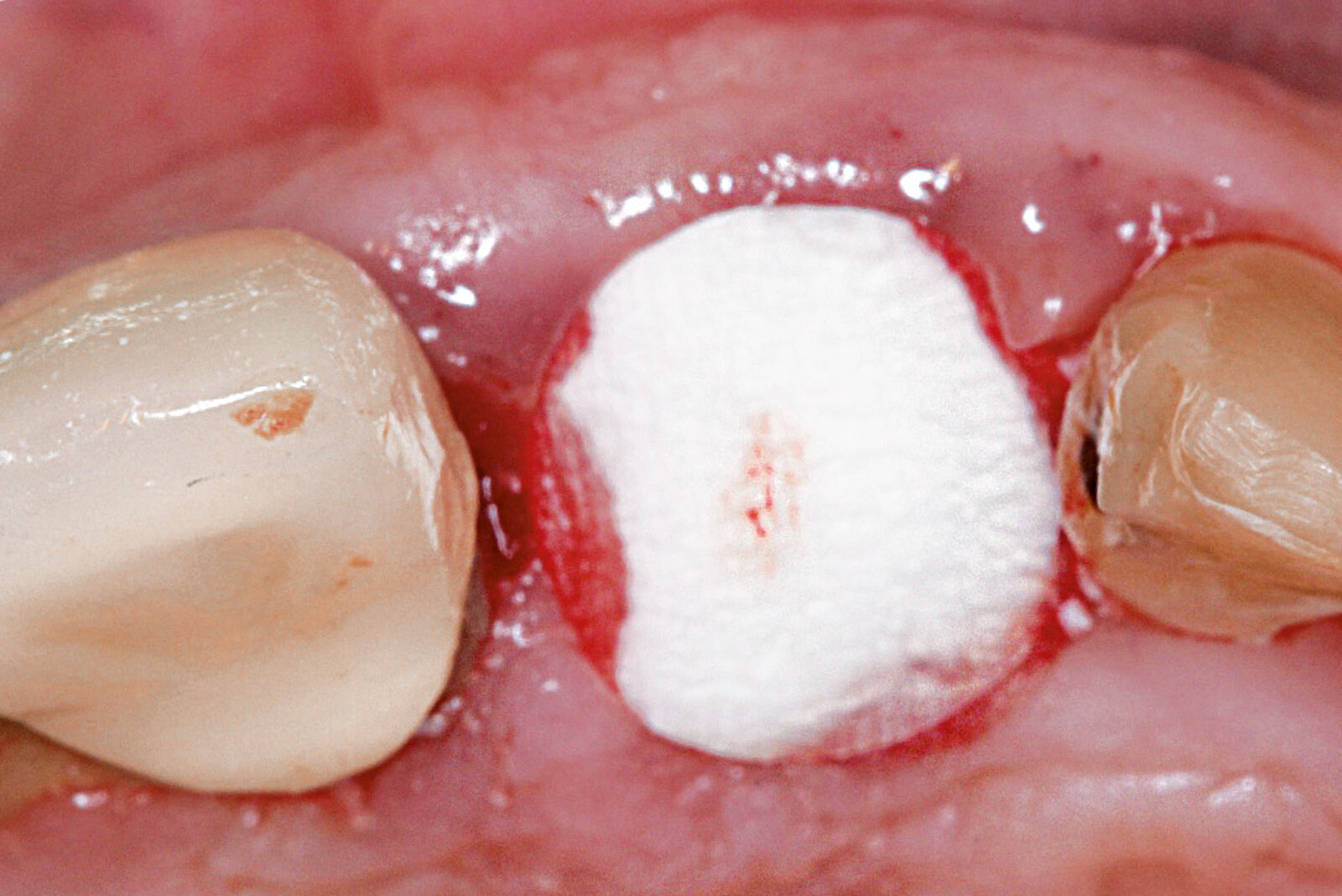 Geistlich USA: Delayed/Late implant placement