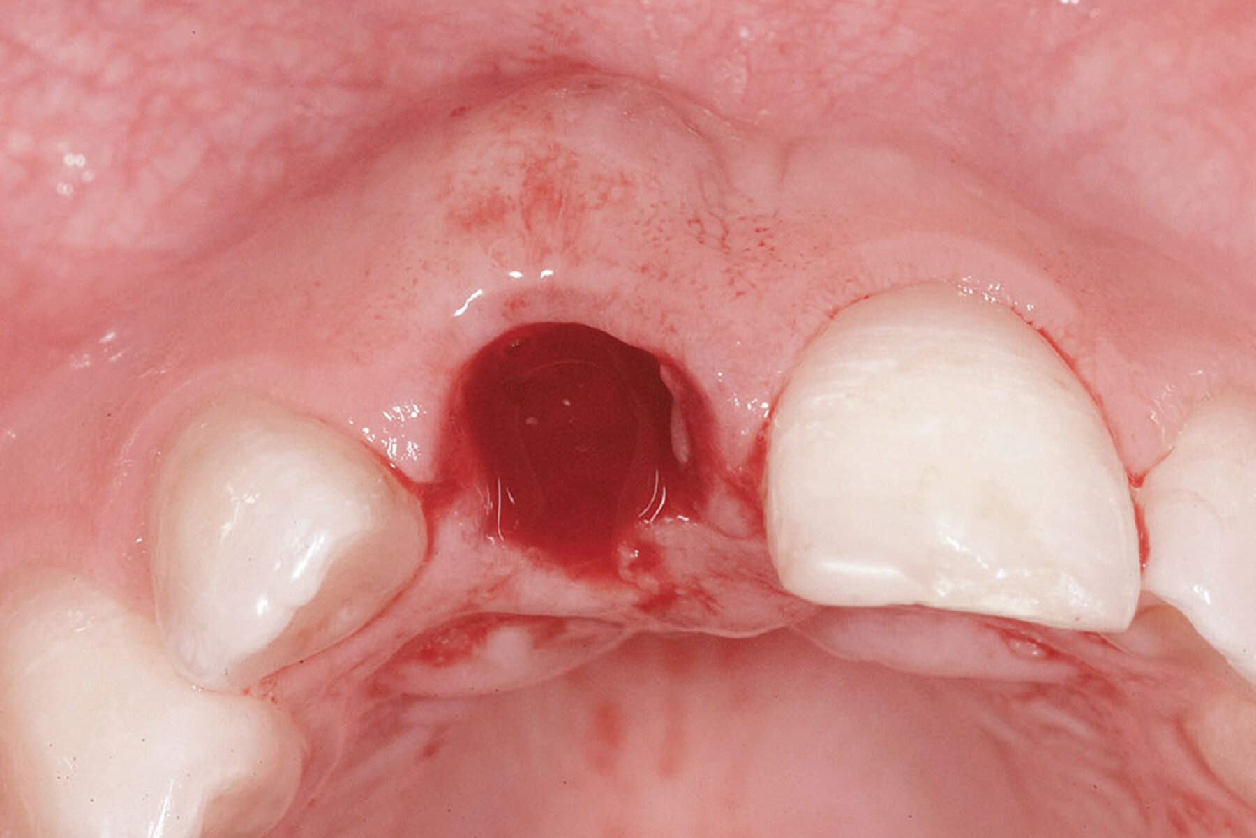 Geistlich USA: Minor Bone Augmentation