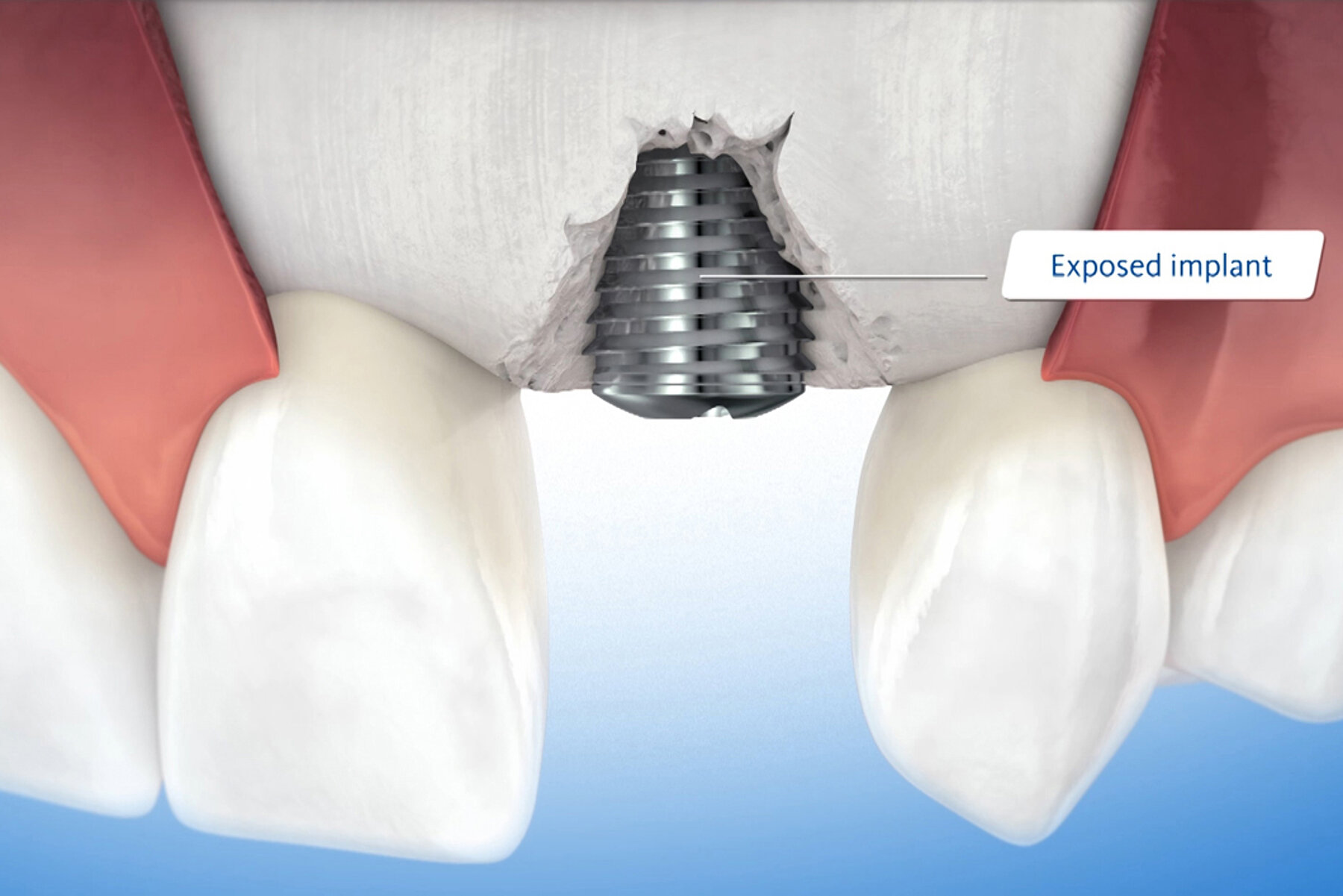 Geistlich USA: Minor Bone Augmentation