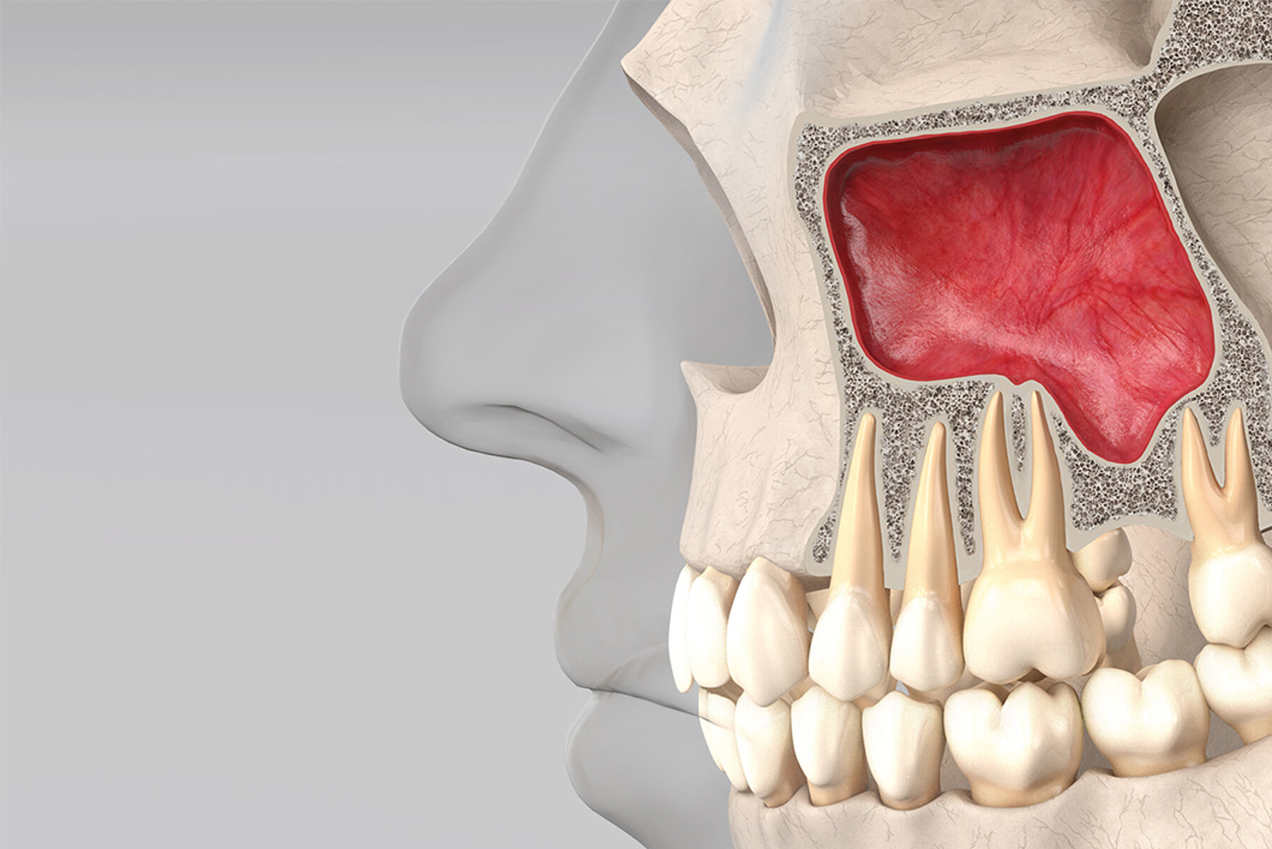 Geistlich USA: Sinus Floor Elevation