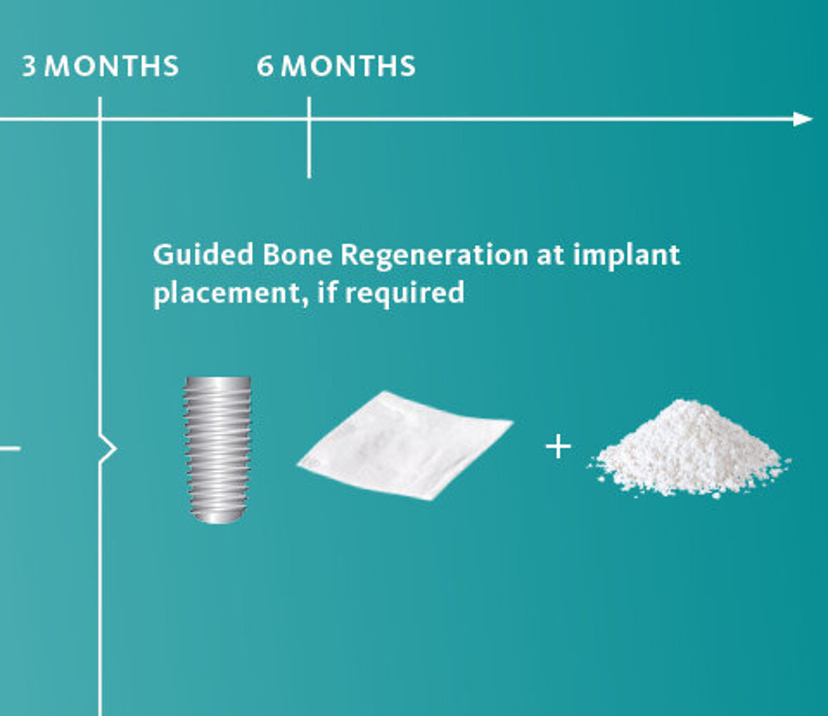 Geistlich USA: Extraction Socket Management
