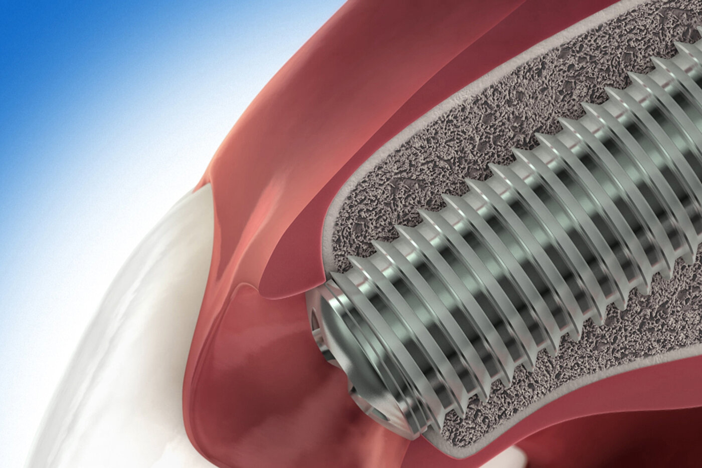 Geistlich USA: Minor Bone Augmentation